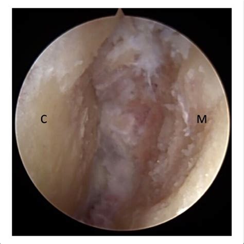 Arthroscopic View Of First Tarsometatarsal Joint After Cartilage