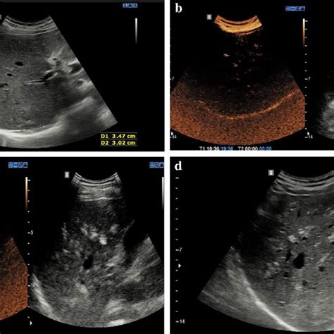 Delayed Heterogeneous Liver Enhancement Phenomenon With Ceus Cases From Download Scientific