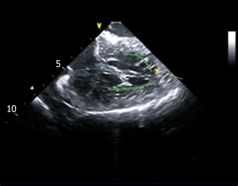 Left Ventricular False Tendons Were Detected By Intracardiac Download Scientific Diagram