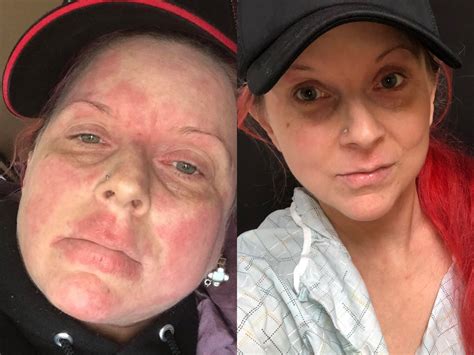 Breast Implant Side Effects Women Share Their Stories Business Insider