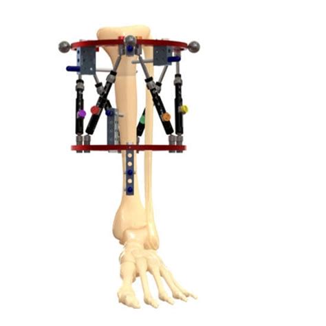 Fixateur Externe De Tibia Orthex Orthopediatrics Circulaire