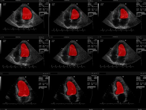 12 Sparse Segmentation Results Overlayed On Ultrasound Images Sequence