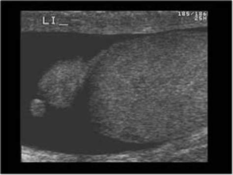 Urinary Tract And Male Reproductive System 2 3 Scrotum Case 2 3 1