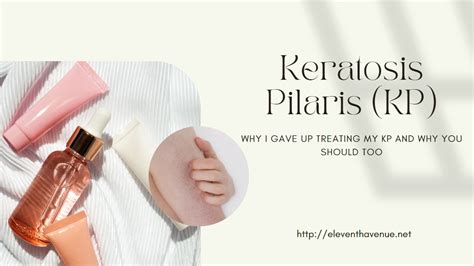 I Gave Up Treating My Keratosis Pilaris Kp And Why You Should Too