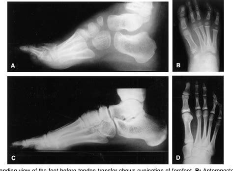 Figure 4 From Anterior Tibial Tendon Transfer In Residual Dynamic
