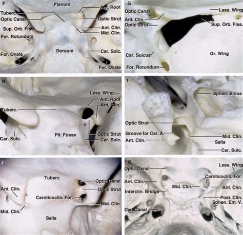 Cavernous Sinus The Neurosurgical Atlas By Aaron Cohen Gadol M D