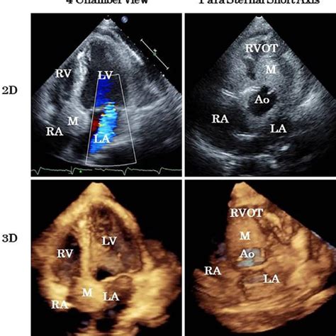 Figure4two Dimensional 2d And Three Dimensional 3d Transthoracic