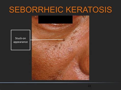 Overview Of Hyperpigmentation Disorders Pptx Skin And Dermatology