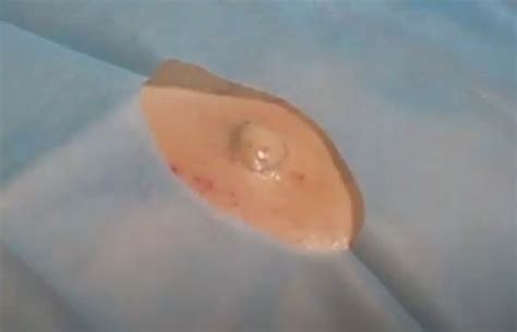 Epidermal Cyst Excision And Removal New Pimple Popping Videos