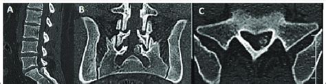 Pre Operative Computed Tomography Scan Showing Benign Bone Lesion Download Scientific Diagram