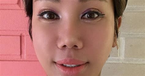 강원래♥ 김송 성형수술 간증인중 축소 33일차→확연히 짧아진 얼굴