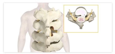Hemilaminectomy Laminectomy Spine Info