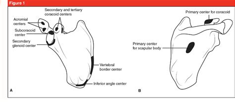 Figure 1 From Glenoid Dysplasia Semantic Scholar