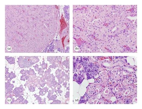 Histology Of The Submandibular Oncocytoma A B The Tumor Is Well