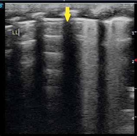 Longitudinal View Of Left Posterior Lung Field With The Arrow Showing