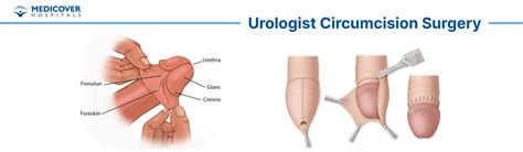Circumcision Surgery Benefits Procedure And Recovery
