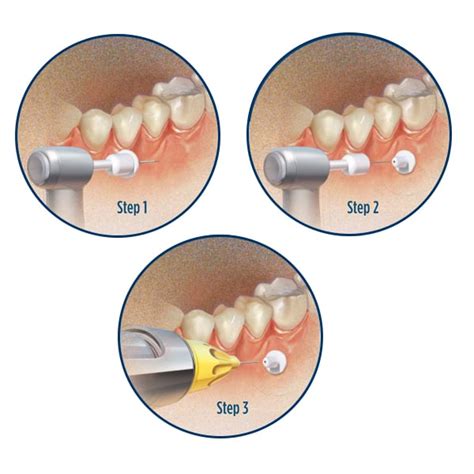 X Tip 10 Pack Starter Kit Intraosseous Anesthesia Delivery Tips Net32