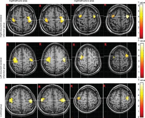 Compensatory Recombination Phenomena Of Neurological Functions In