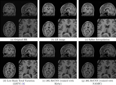 Figure 14 From Multiscale Brain Mri Super Resolution Using Deep 3d Convolutional Networks