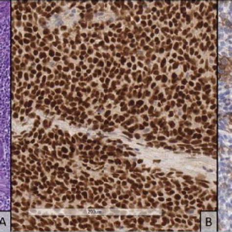 A The Lesion Is Composed By Nodules Of Small Round Cells Separated