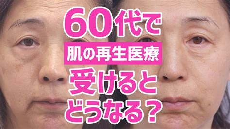 50代からの顔のたるみエイジングケア治療「肌の再生医療」ビフォーアフター｜60代 女性｜6ヶ月検診 Youtube