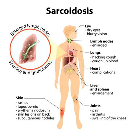 Sarcoidosis Of The Skin Cutaneous Sarcoidosis — Foundation For