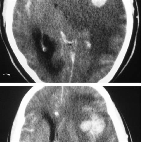 Axial Brain Ct Scan Without Contrast Shows A Heterogeneous Hyperdense
