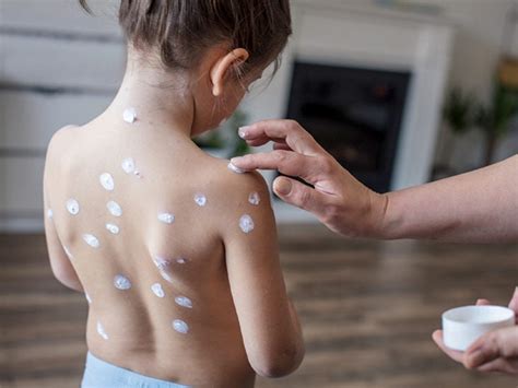 Chicken Pox Scars On Arms