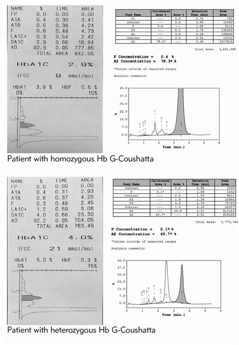 Ion Exchange HPLC Chromatogram For HbA C And Hb Variants Analysis Of Download Scientific