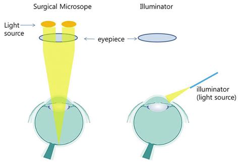 Schematic Diagram Of Conventional Surgical Microscope And Illuminator Download Scientific Diagram