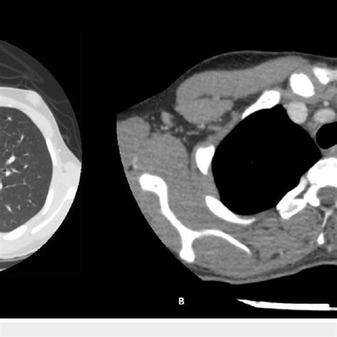 Contrast Enhanced High Resolution Computed Tomography Hrct Scan Of