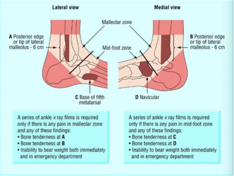 Ankle Sprain Flashcards Quizlet