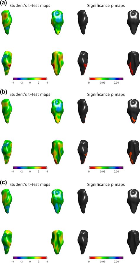 A Shape Differences Between Asd And Control Group Segmentations