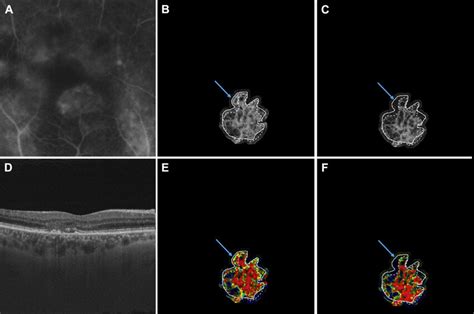 Multimodal Longitudinal Imaging Of Chronic Choroidal Neovascularization Download Scientific