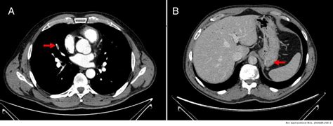 Submucosal Gastric Lesion