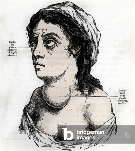 Goiter In Graves Disease