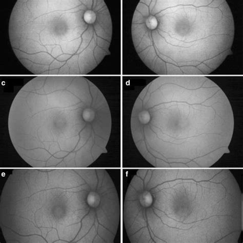 Serial Humphrey Visual Field 24 2 Total And Pattern Deviation Plot At Download Scientific