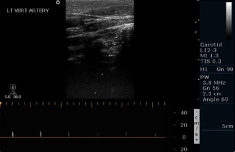 Figure 1 From Hypoplastic Vertebral Artery As A Predisposing Cause For