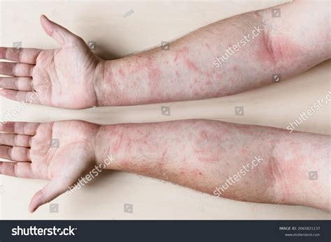 Irritant Contact Dermatitis Hand