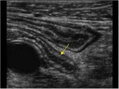 Normal Appendix Ultrasound