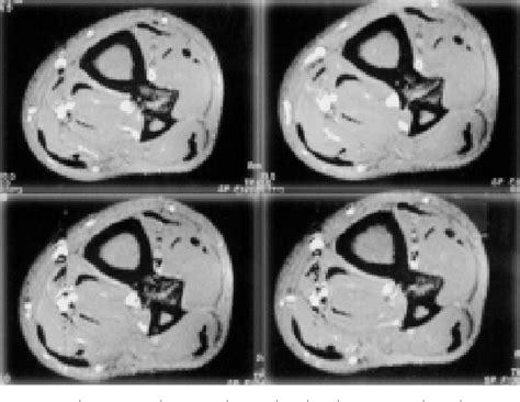 Figure 2 From Tibiofibular Synostosis In A Military Soldier Semantic Scholar