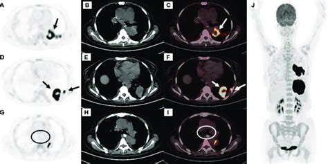 A C High Fdg Uptake At The Dorsal Segment Of The Left Lower Lobe A