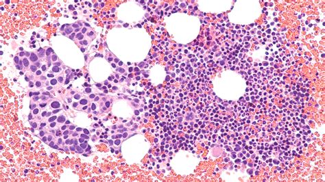 Metastatic Breast Cancer What You Should Know Black Health Matters