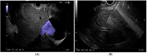 Liver Biopsy Eus At Nathan Lozano Blog