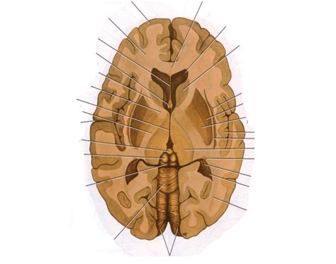 Structures Of Brain Axial View Usmle Quiz