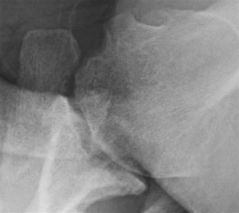 Uw Shoulder And Elbow Academy Interpositional Biologic Resurfacing Then Infection Then Ream And Run