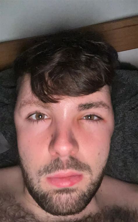 Mans Head Swells Like A Balloon As He Ignores No Sex Rule After