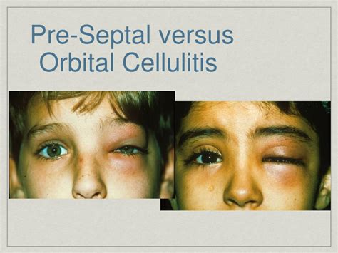 Ppt Essentials Of Ophthalmology Powerpoint Presentation Free