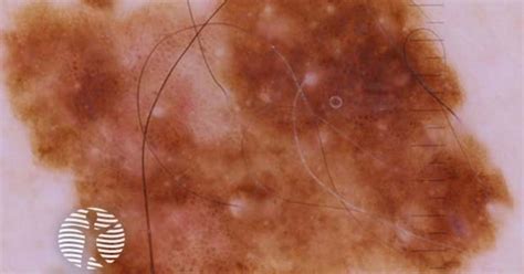 Superficial Spreading Melanoma Breslow 03mm Polarised Dermoscopy