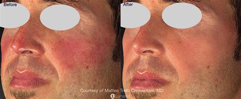 Rosacea Main Street Skin Clinic
